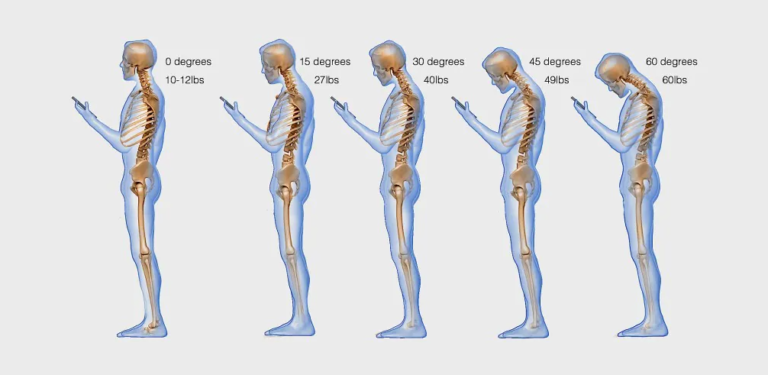 How To Fix 'Tech Neck' (And Eliminate The Pain That Comes With It ...