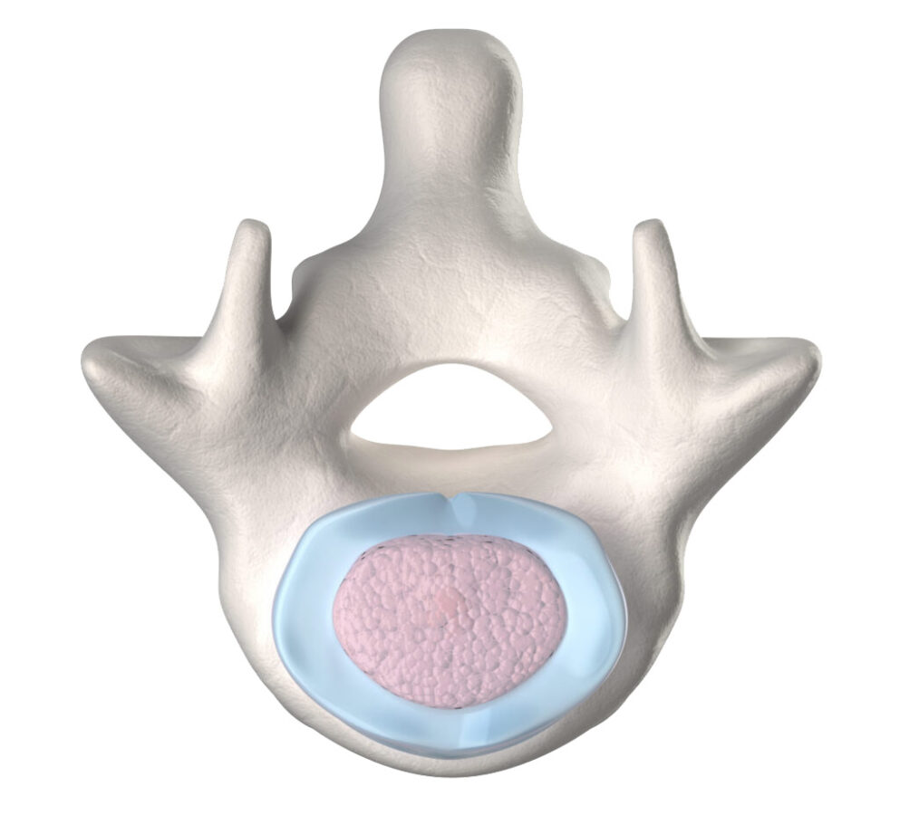 How To Reverse Degenerative Disc Disease | Ascent Chiropractic