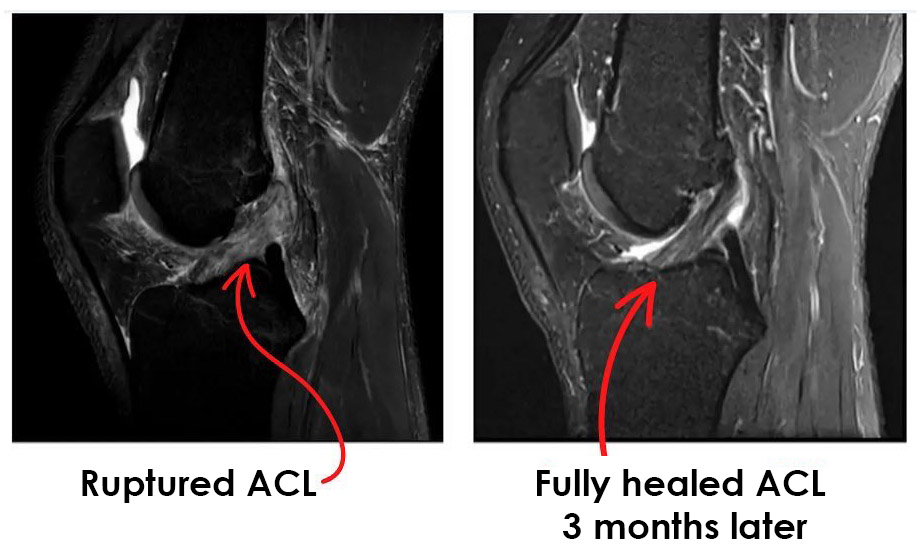 Can An Acl Tear Heal Without Surgery Ascent Chiropractic